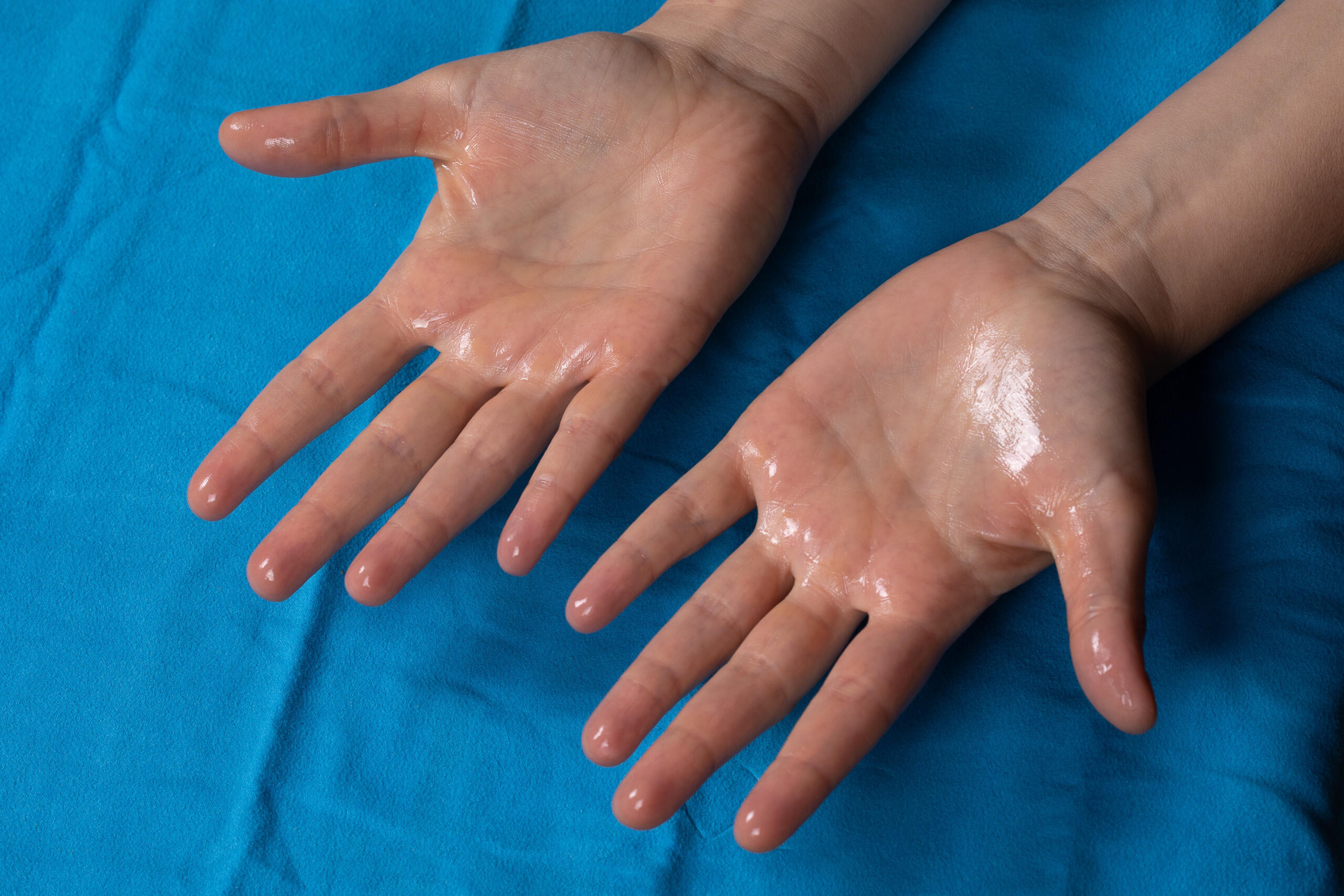 What Is Hyperhidrosis Keep Asking